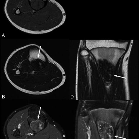 A 12 Year Old Man With Nonossifying Fibroma Of The Right Tibia