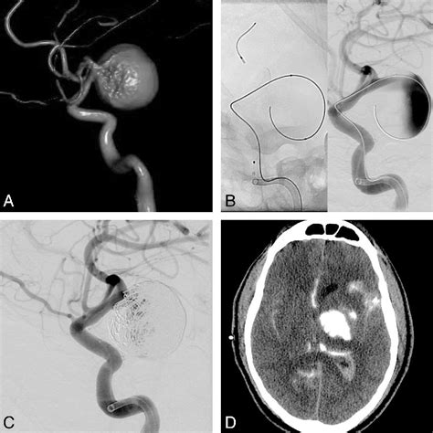 Figure 3 From Pipeline Embolization Device In Aneurysmal Subarachnoid Hemorrhage Semantic Scholar