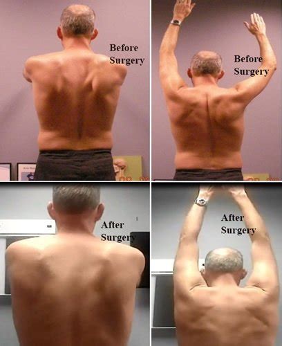 Upper Panel Pre Operative Photographs Showing Clearly Winged Scapula
