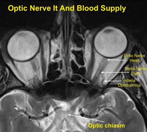 What Is Naion And Is Eyesight Loss Irreversible Research And Practice