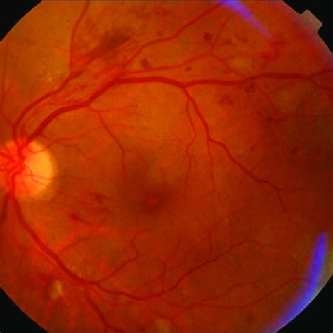 Abbreviated Summary Of Etdrs Final Retinopathy Severity Scale For