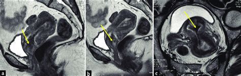 A 49 Year Old Female Presenting With Pain And Pv Bleeding With