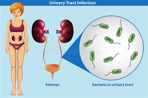 Infección De Vías Urinarias Humana Ilustración Del Vector Ilustración De Riñón Zona 120007415