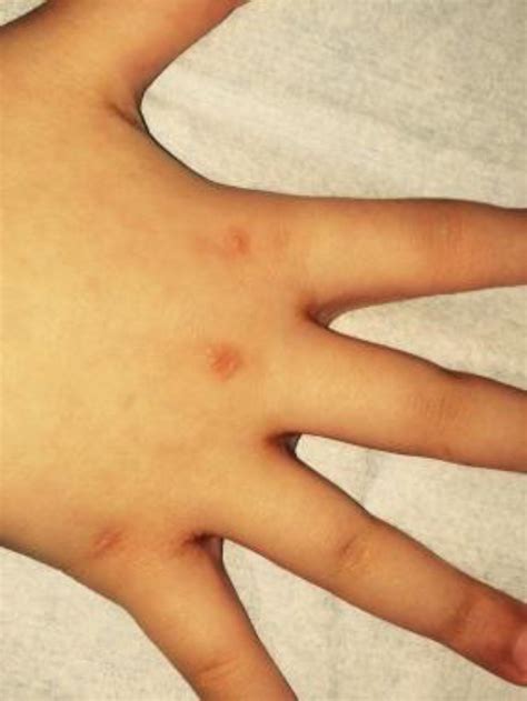 Cutaneous Cholesterol Deposits Right Hand After 12 Months Of Therapy