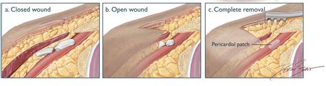 Clinical Management Of The Impella 55 Pump The Journal Of Heart And