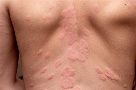 Premium Photo Psoriasis Vulgaris Skin Patches Are Typically Red Itchy