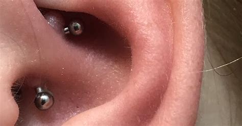 Daith Irritation Bump Album On Imgur