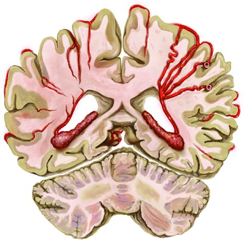 Schematic Illustration Showing Choroidal Anastomosis Left Hemisphere