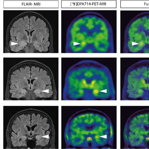 18 F Dpa 714 Pet Mri Of Patients With Autoimmune Limbic Encephalitis