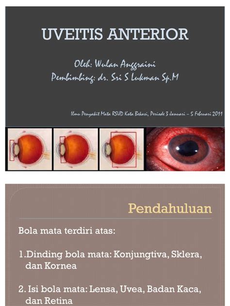 Uveitis Anterior Ppt Percobaan Pdf