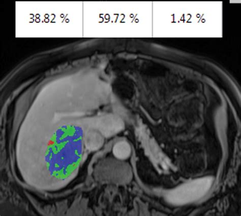 Unresectable Intrahepatic Cholangiocarcinoma Multiparametric Mr Imaging To Predict Patient