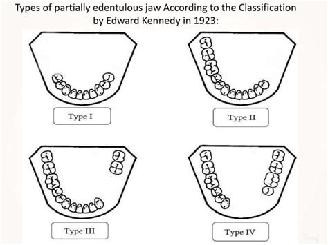 Designing A Removable Partial Denture Kennedys Classification Pptx
