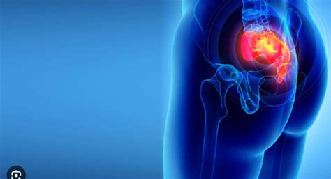 Pilonidal Cyst Diagnosis And Treatment