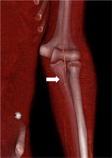 Computed Tomography Angiogram Showing Acute Arterial Occlusion Of The