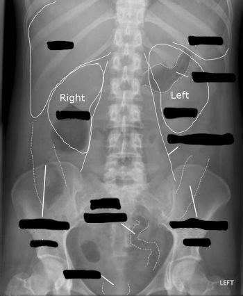 X Ray Abdomen Anatomy Part 1 Diagram Quizlet