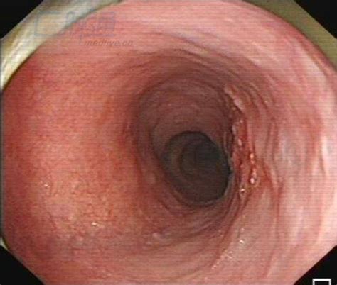 食管癌蕈伞型图片食管髓质型图片蕈形状图片大山谷图库