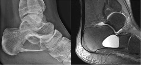 Unicameral Bone Cyst Calcaneus Surgery Unicameral Bone Cyst Calcaneus Surgery