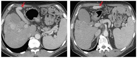 Right And Extended Right Hepatectomy Abdominal Key