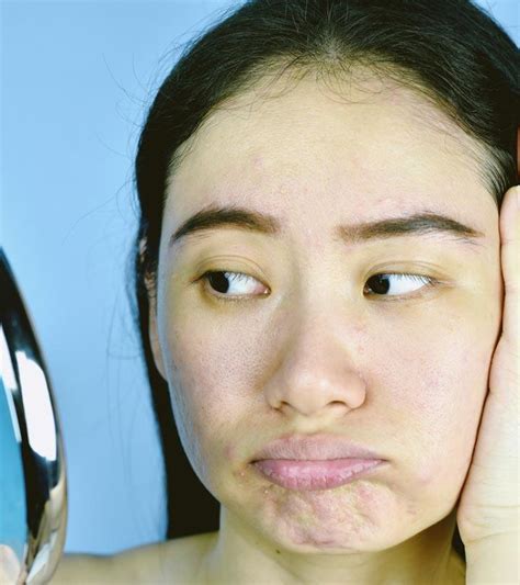 5 Home Remedies For Congested Skin Symptoms And Treatment