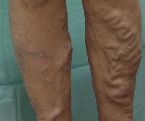 Tipos De Varices Existen Diferentes Tipos De Varices Y By Varices10