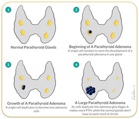 Intraoperative Pth Testing Parathyroid