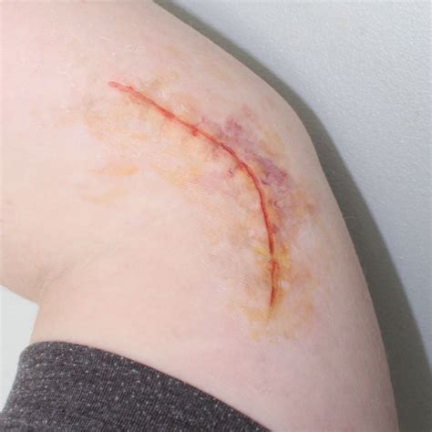 How To Remove Stitches Safely At Home Artofit