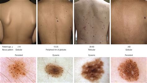 Types Of Abnormal Moles