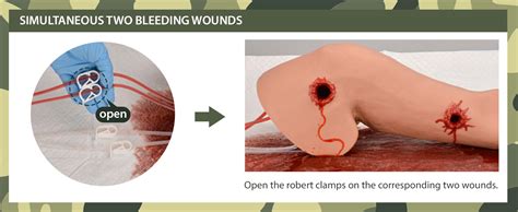 Wound Packing Vs Tourniquet At Paige Odriscoll Blog