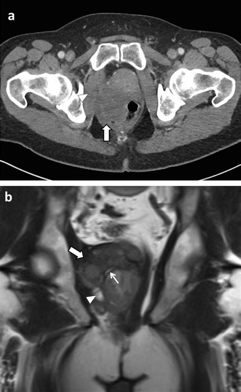 44 Year Old Man With Prostatic Synovial Sarcoma Presented With Perineal Download Scientific
