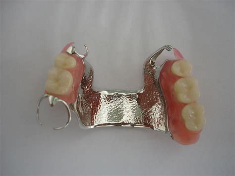 Dental Removable Partial Denture Design At Arlene Jordan Blog