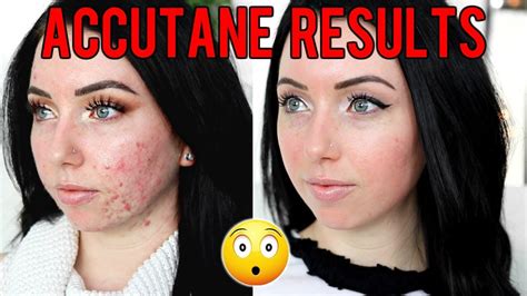 Accutane Before And After Body