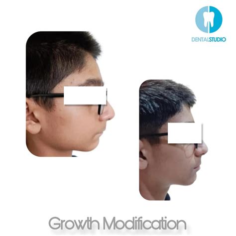 Dental Skeletal Class Ii Growth Modification Facebook