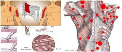 Síndrome Miofascial Causas Síntomas Diagnóstico Tratamiento Y