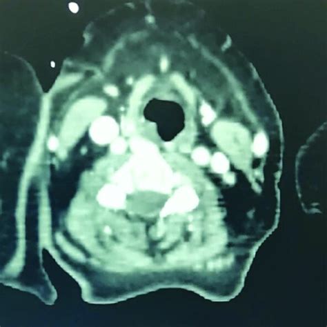 Computed Tomography Axial Section Showing The Obstructive Lesion