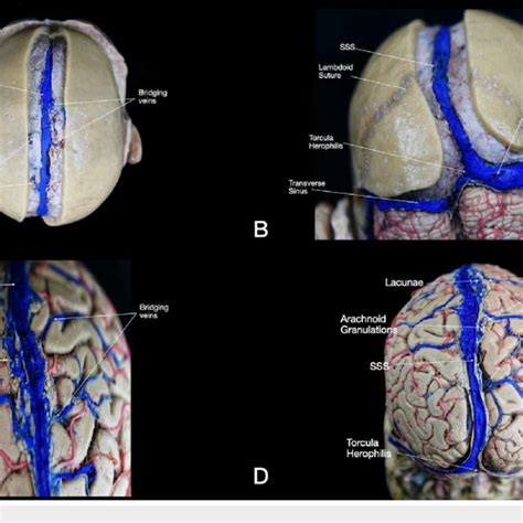 Straight Sinus Cadaver