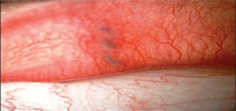 Two Cases Of Posterior Ectopic Cilia A Brief Report Journal Of