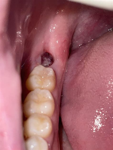 Do These Look Like Dry Socket Day 3 After Getting Wisdom Teeth Out R Wisdomteeth
