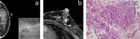 A A 40 Year Old Premenopausal Female Who Underwent Screening