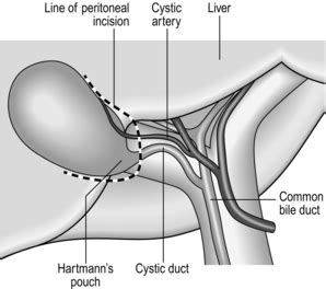 Hartmanns Pouch