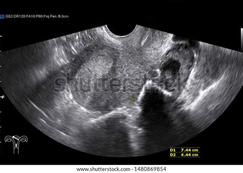 Bicornuate Uterus Ultrasound Spontaneous Twin Pregnancy In Uterus