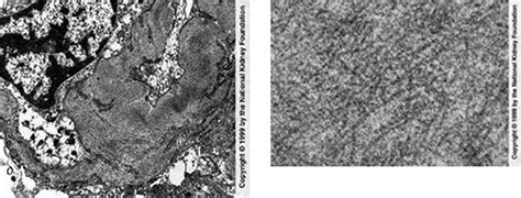 Fibrillary And Immunotactoid Glomerulopathies Genitourinary Disorders Merck Manual