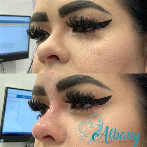 Nose Fillers Case No 1353 Albany Cosmetic And Laser Centre Edmonton