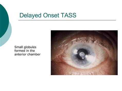 Toxic Anterior Segment Syndrome Ppt