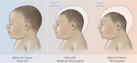 Microcephaly Newborn