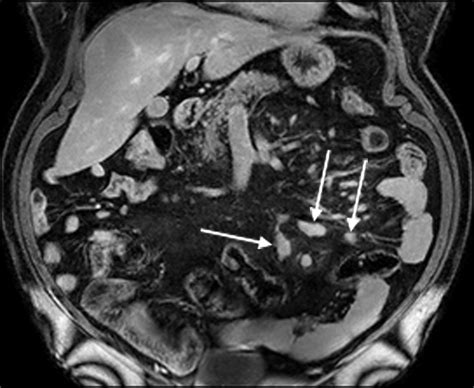 Ct And Mr Enterography In The Evaluation Of Celiac Disease Radiographics