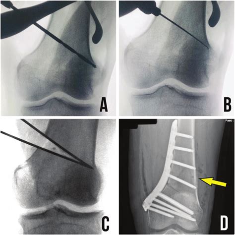 Intraoperative Tips For The Proper Management Of An Osteotomy Ott