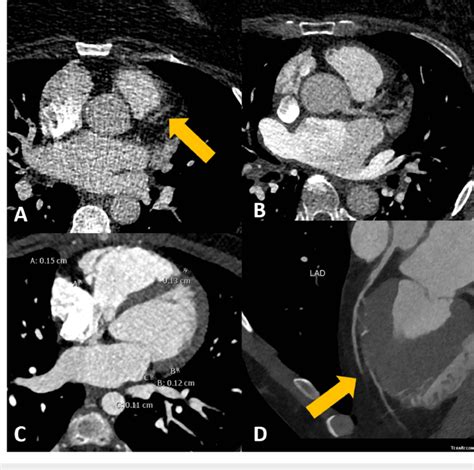 Ccta Images Demonstrating Cardiac Motion Respiratory Motion And Poor Download Scientific