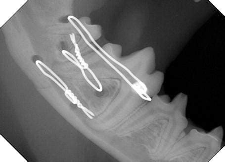 Broken Jaw X Ray