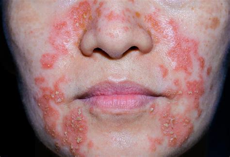 Seborrheic Dermatitis Dr Şermin Filiz Acıpayam