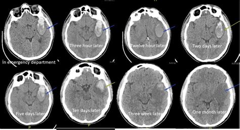 Epidural Hemorrhage